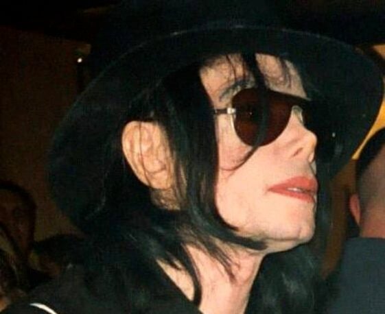 How Did Michael Jackson Turn White? The Facts About His Skin Condition